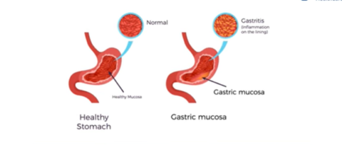 Gastric Ulcers vs Stomach Cancer: Key Differences to Know